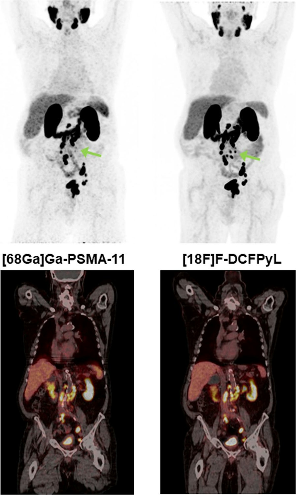 Is Pylarify better than Ga-68 PSMA-11 for prostate cancer imaging ...