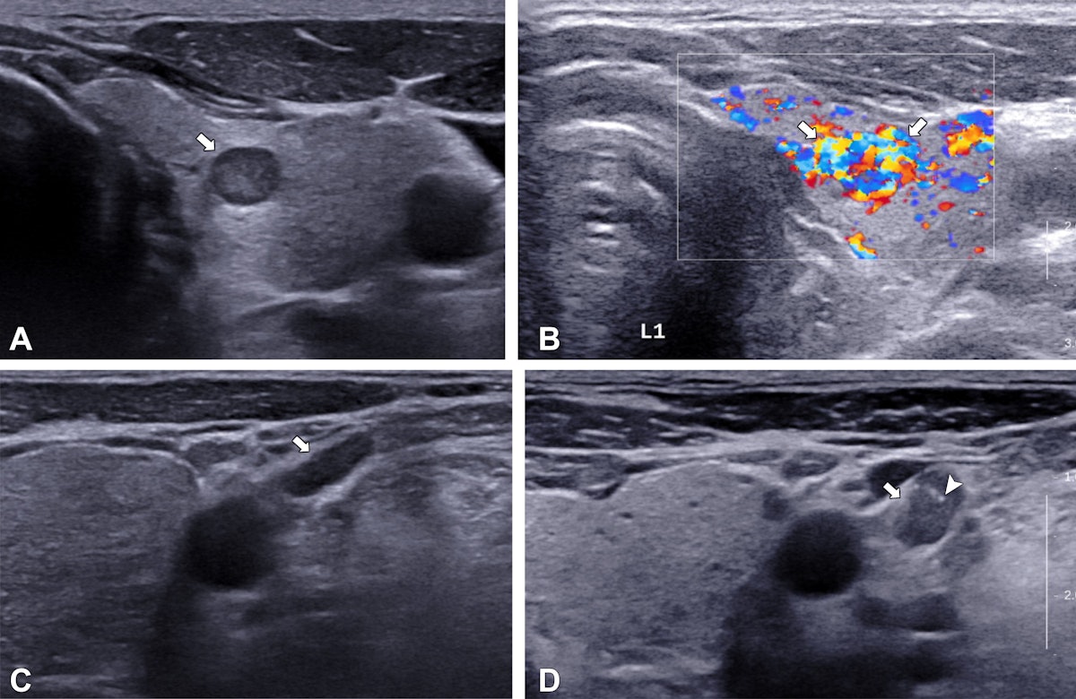 Ultrasound Features Tied To Thyroid Microcarcinoma Tumor Growth Auntminnie