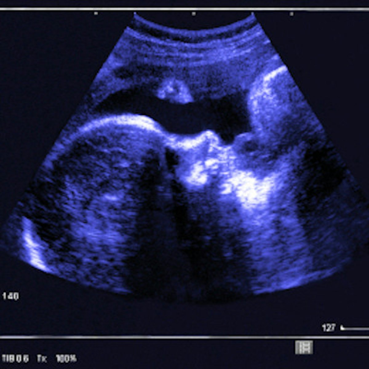 Deep-learning method using ultrasound predicts fetal birth weight ...