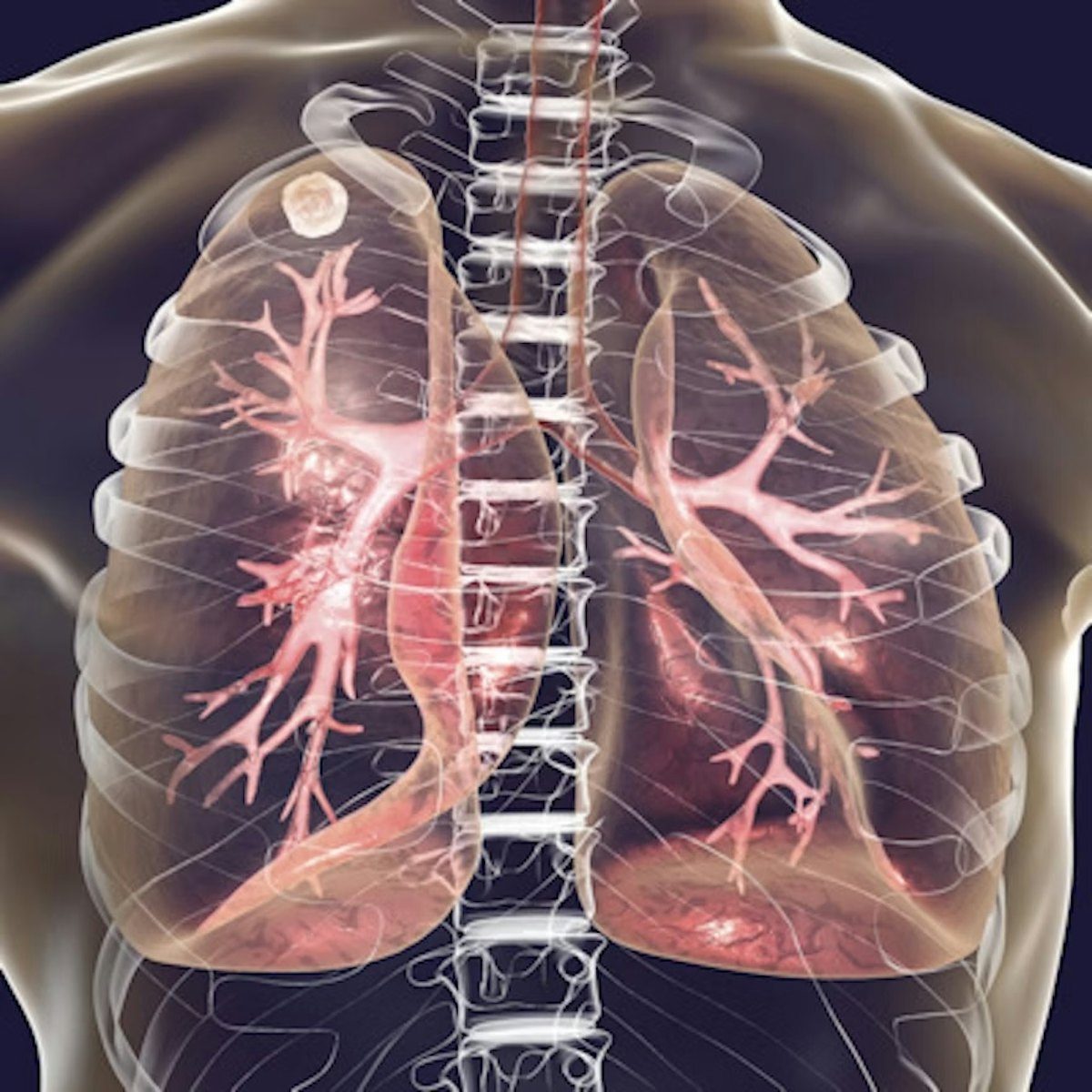 'Timika score' on x-rays may help identify complex TB cases | AuntMinnie