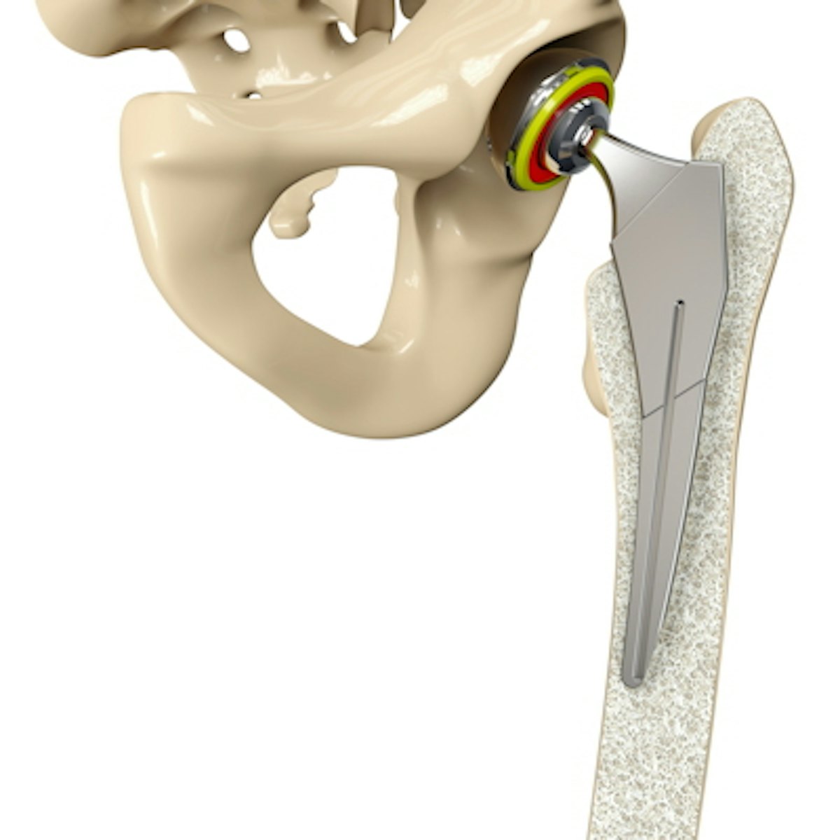 AI model helps plan hip replacements | AuntMinnie