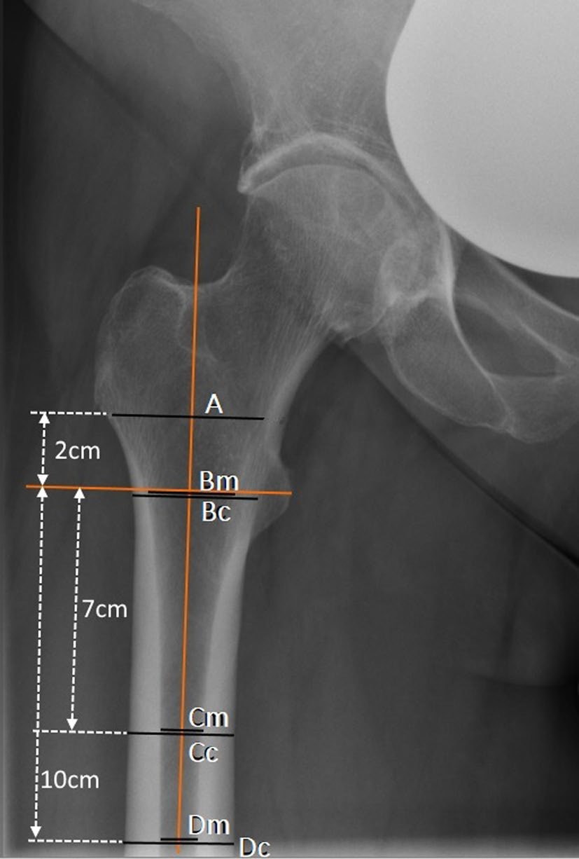 Hip X Rays Help Screen For Osteoporosis In Tha Patients Auntminnie