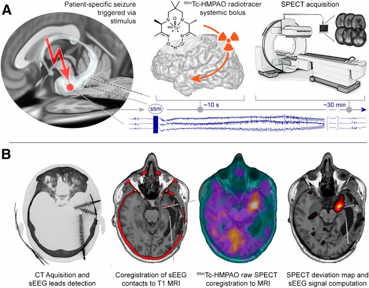 Can ictal SPECT make a comeback in epilepsy patients? | AuntMinnie