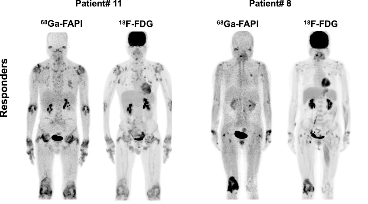 FAPI-PET predicts treatment response in patients with rheumatoid ...