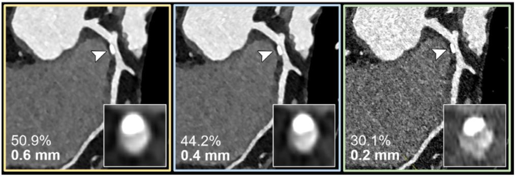 PCCT improves assessment of coronary artery disease | AuntMinnie