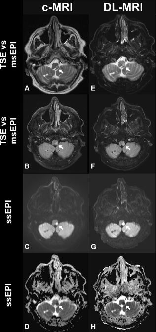Deep-learning accelerated brain MRI improves stroke lesion detection ...