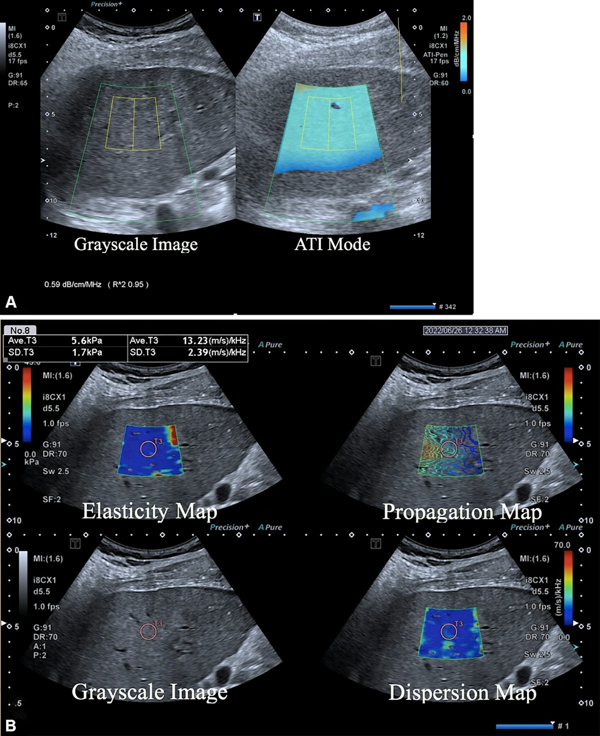 Ultrasound model predicts liver disease progress | AuntMinnie
