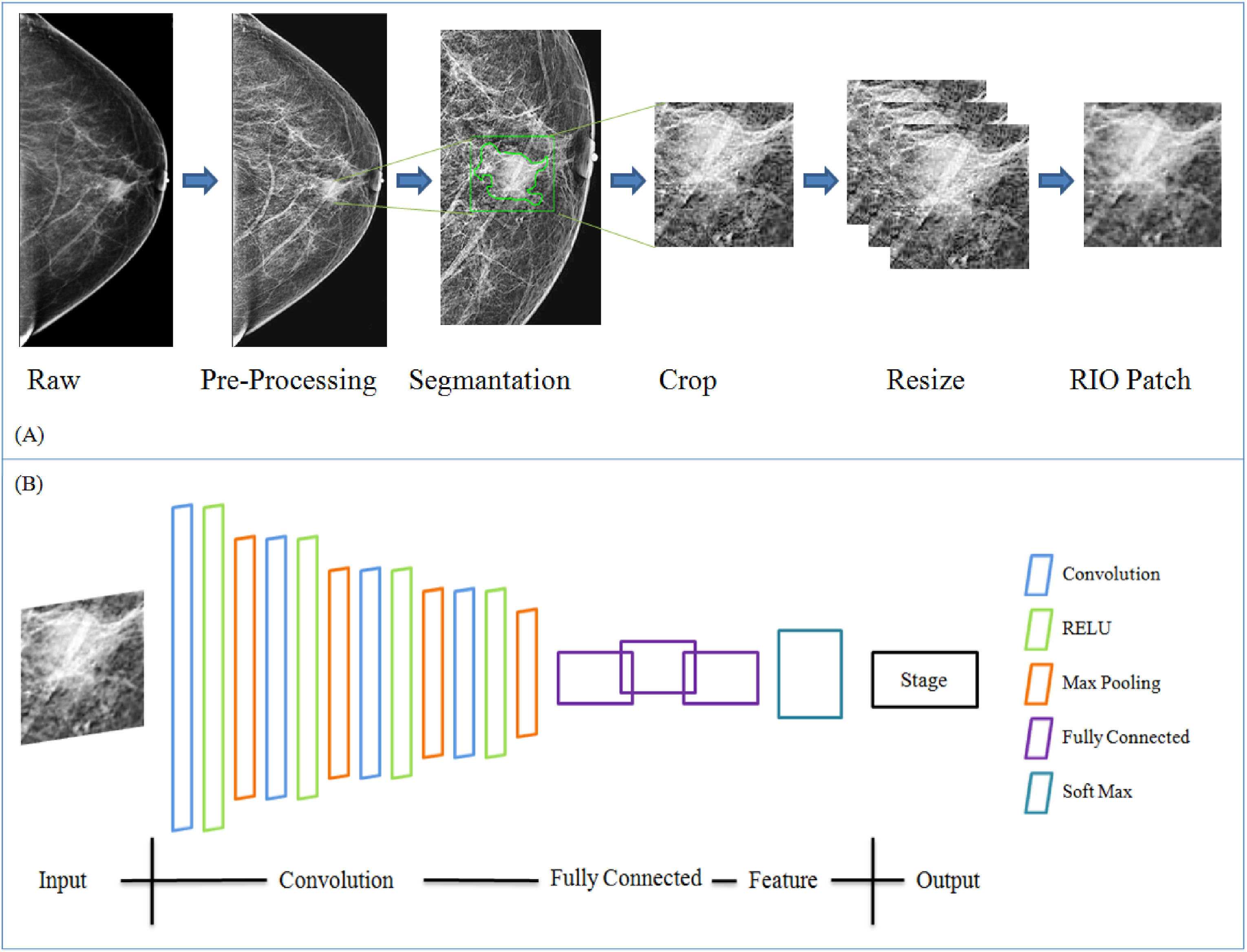 Deep-learning model determines breast tumor staging | AuntMinnie