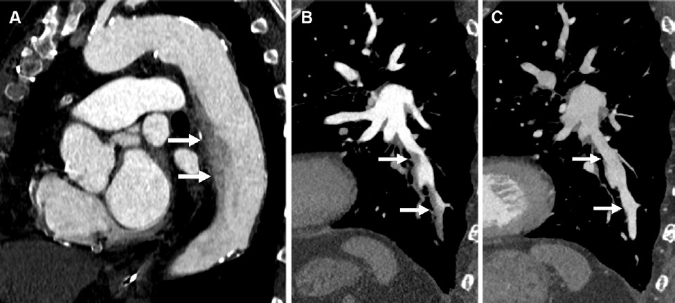 Understanding CT flow artifacts is key to better disease diagnosis ...
