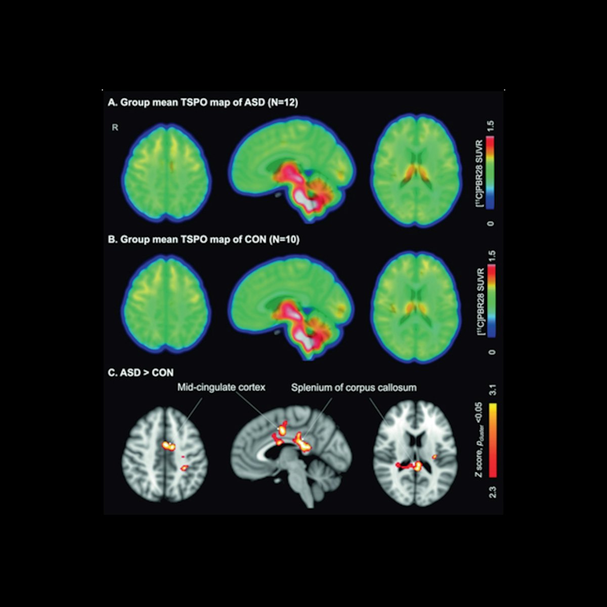 PET/MRI reveals sex differences in patients with autism | AuntMinnie