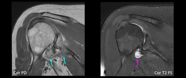 ARRS: Shoulder MRI shows high AIGM prevalence in fatty infiltration ...
