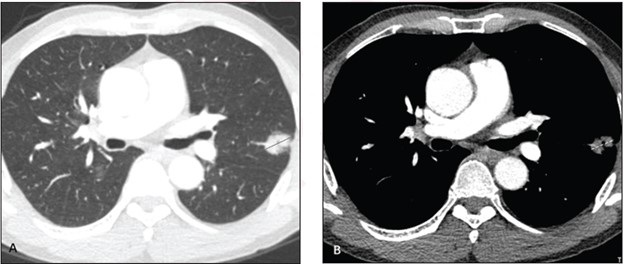 Ground-glass opacity on CT lung cancer imaging means better prognosis ...
