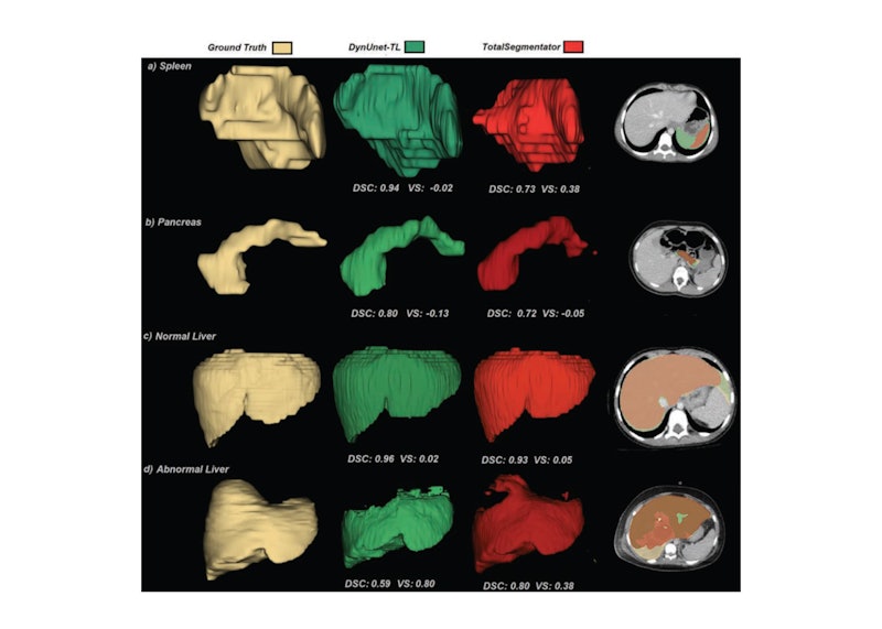 Automatic Organ Segmentation Model Available For Testing With Pediatric Cts Auntminnie