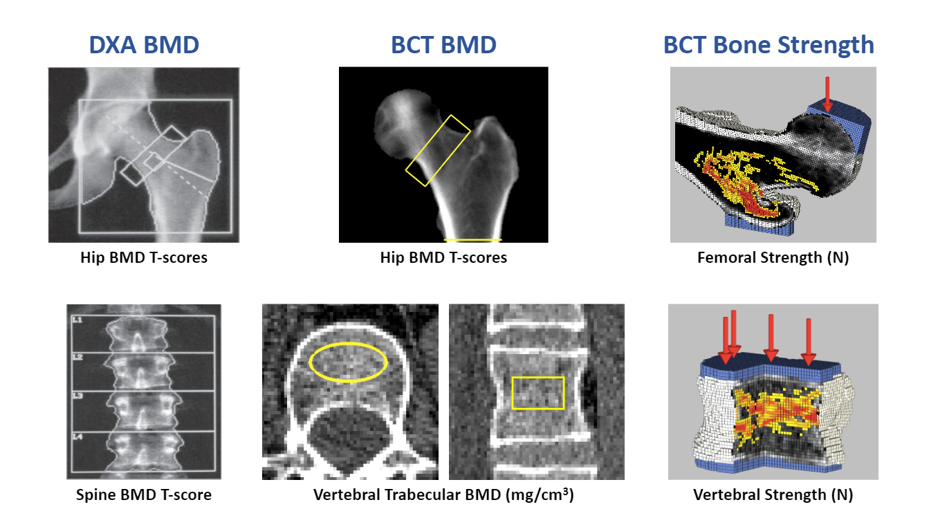 UC Berkeley researchers develop CT-based 'virtual stress test' for BMD ...