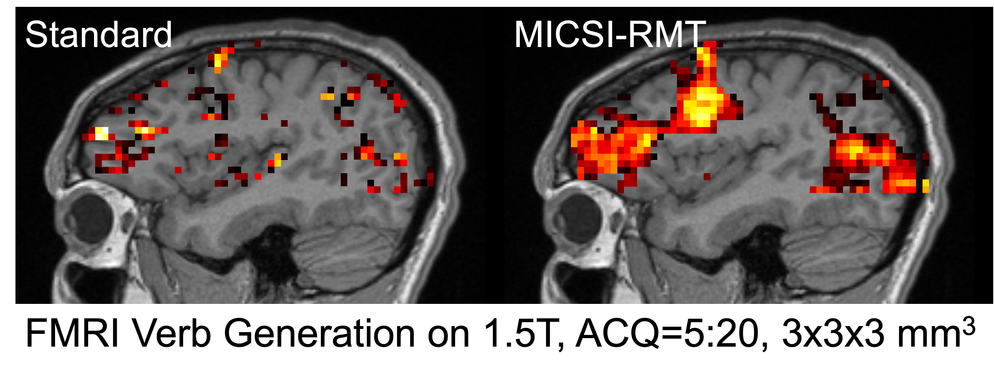 FDA grants MICSI 510(k) for brain MRI image enhancement algorithm ...