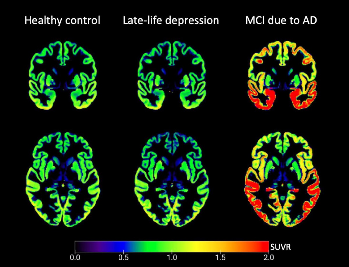 PET/MRI rules out tau protein in late-life depression | AuntMinnie