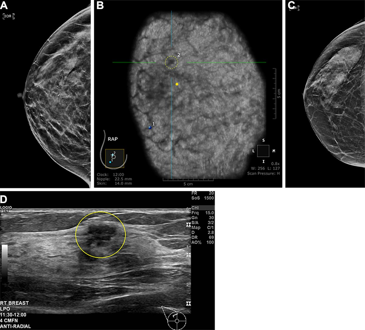 mammogram screening abnormality