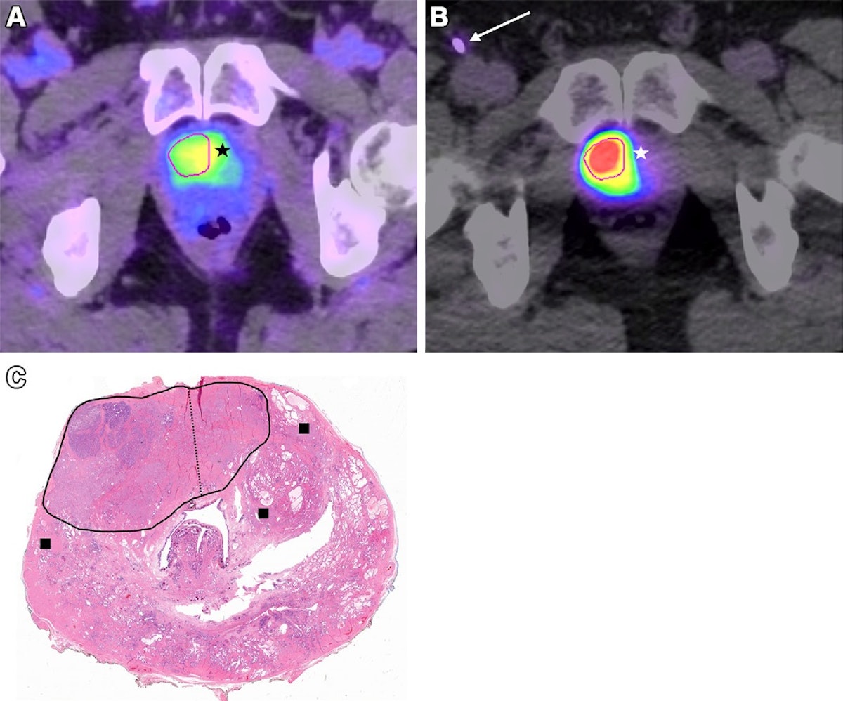New theranostics delivery route tested for prostate cancer | AuntMinnie