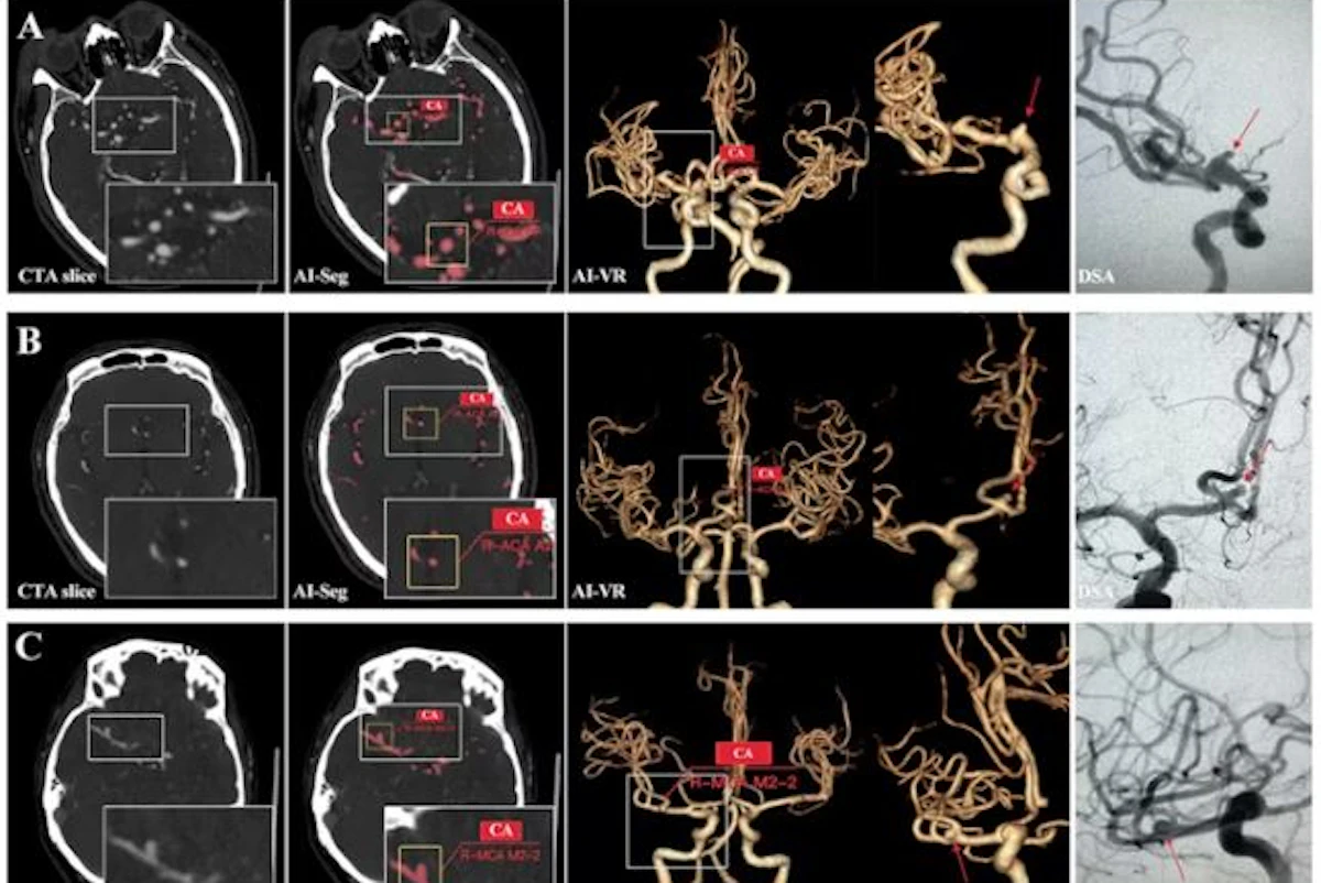 AI model can detect, segment cerebral aneurysms on CTA | AuntMinnie