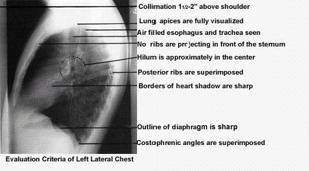Mastering AP and lateral positioning for chest x-ray | AuntMinnie