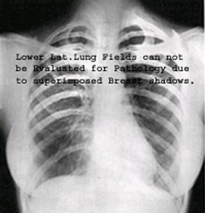 Good positioning is key to PA chest x-ray exams | AuntMinnie