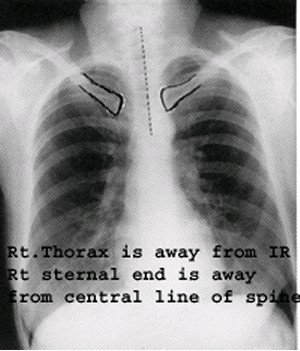 Good positioning is key to PA chest x-ray exams | AuntMinnie