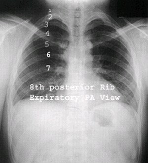Good positioning is key to PA chest x-ray exams | AuntMinnie