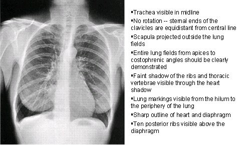 Good positioning is key to PA chest x-ray exams | AuntMinnie