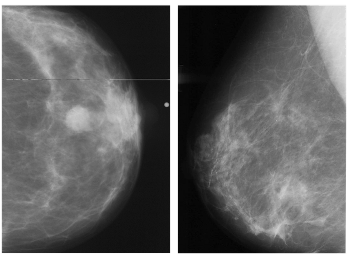 abnormal mammogram