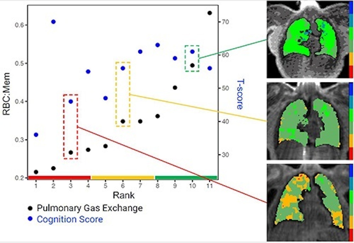 MRI links long-COVID brain fog to lung function | AuntMinnie