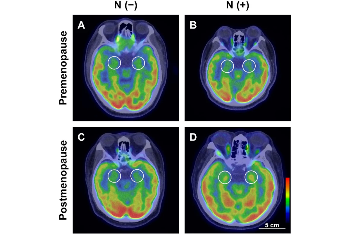 PET links chronic stress to aggressive endometrial cancer | AuntMinnie