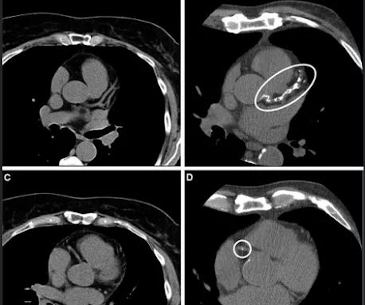 Cardiac calcium score screening CT can also detect lung cancer | AuntMinnie