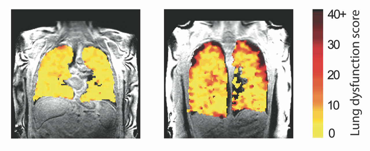New MRI method shows treatment effects in lung transplant patients ...