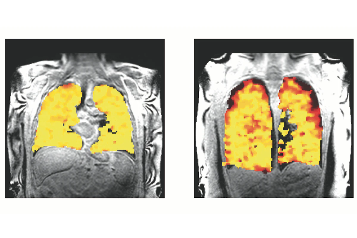 New MRI method shows treatment effects in lung transplant patients ...