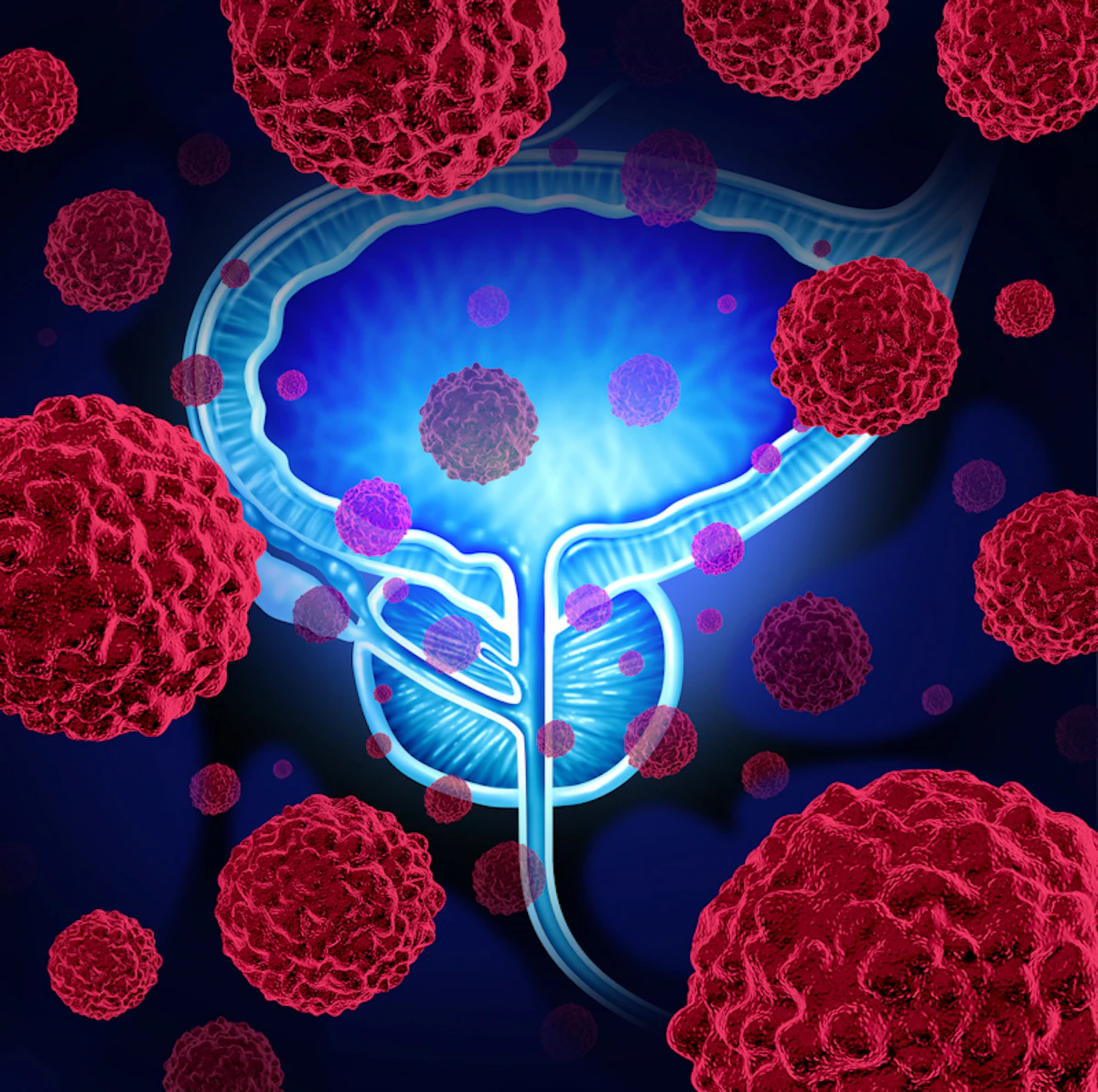 PI-RR system effective for predicting prostate cancer recurrence ...