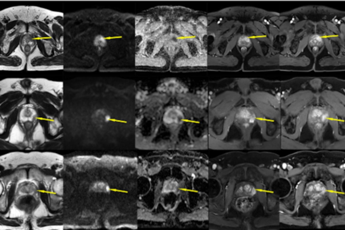 Simulated contrast-enhanced MRI helps assess prostate cancer | AuntMinnie
