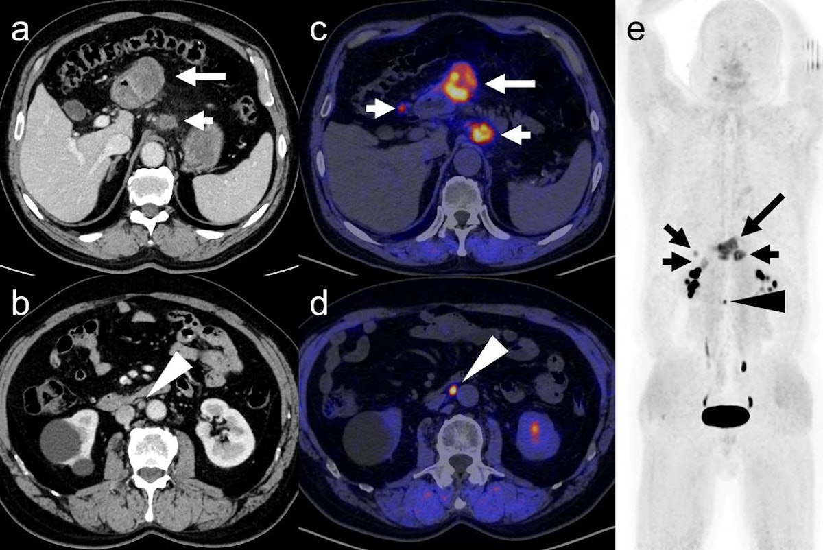 FAPI-PET shows promise for imaging gastric cancers | AuntMinnie