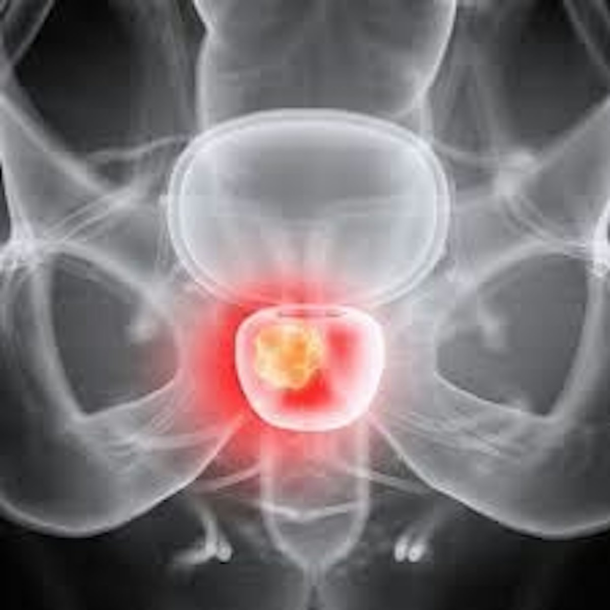 FDA fast-tracks Clarity’s prostate cancer treatment | AuntMinnie