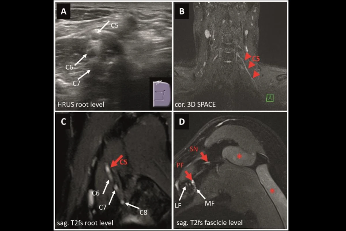 MRI, ultrasound have tradeoffs in diagnosing neuropathies | AuntMinnie