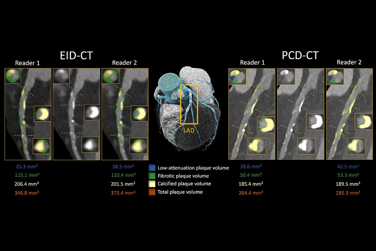 PCCT bests conventional CT for quantifying coronary plaque | AuntMinnie