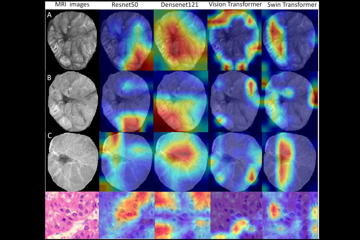 Deep-learning plus MRI helps predict HCC recurrence | AuntMinnie