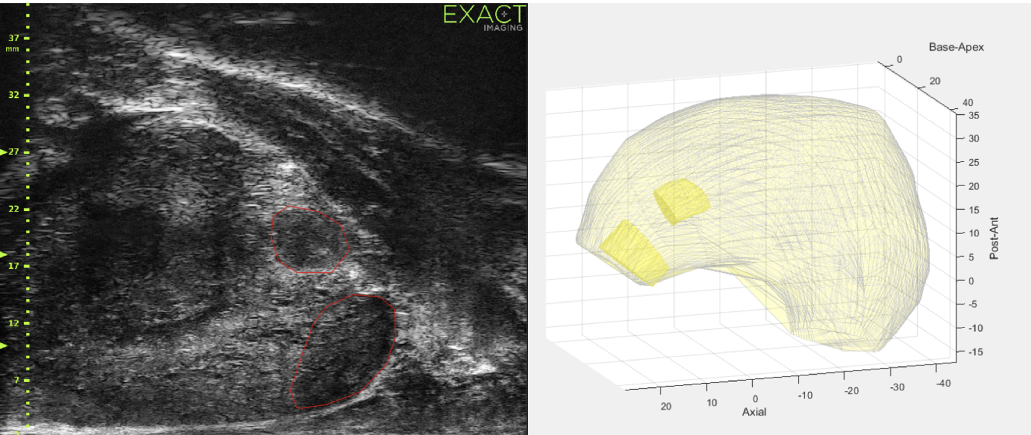 Microultrasound on par with MRI in predicting prostate tumor volume ...