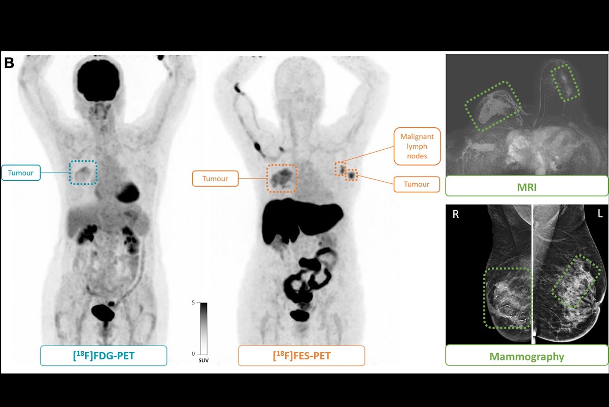FES-PET shows promise staging patients with low-grade breast cancer ...