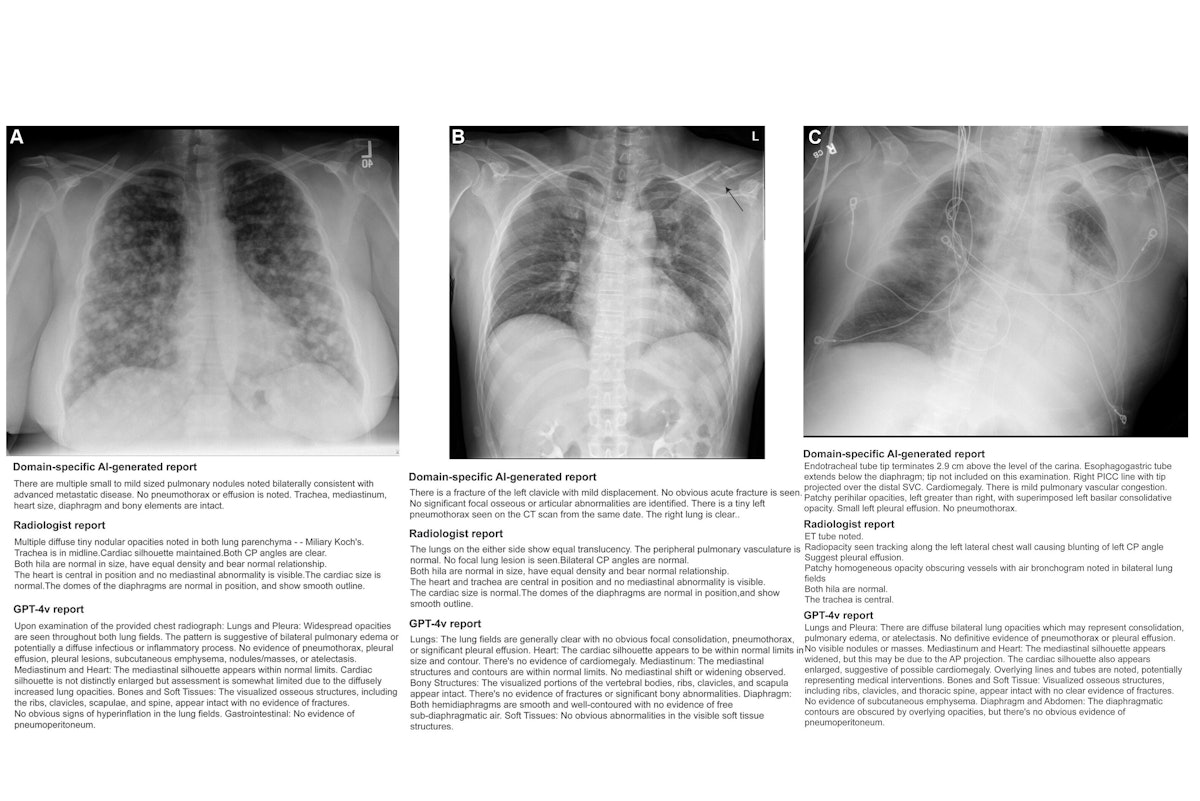 Generative AI model shows promise in chest x-ray study | AuntMinnie