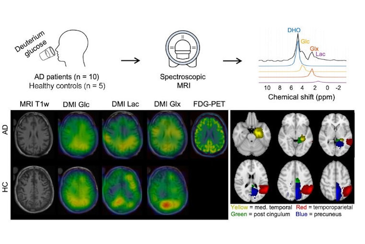 Metabolic MRI technique shows promise in Alzheimer’s patients | AuntMinnie