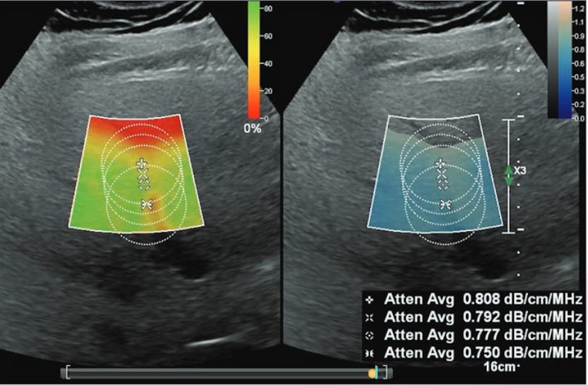Ultrasound AC measures help detect liver steatosis | AuntMinnie