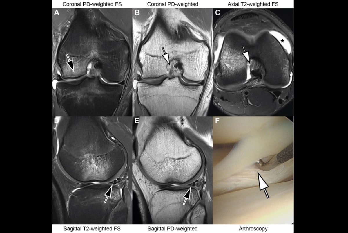 simultaneous multi slice mri