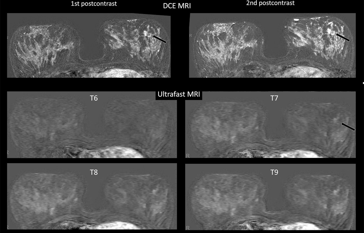 Ultrafast breast MRI may need to be reconsidered | AuntMinnie