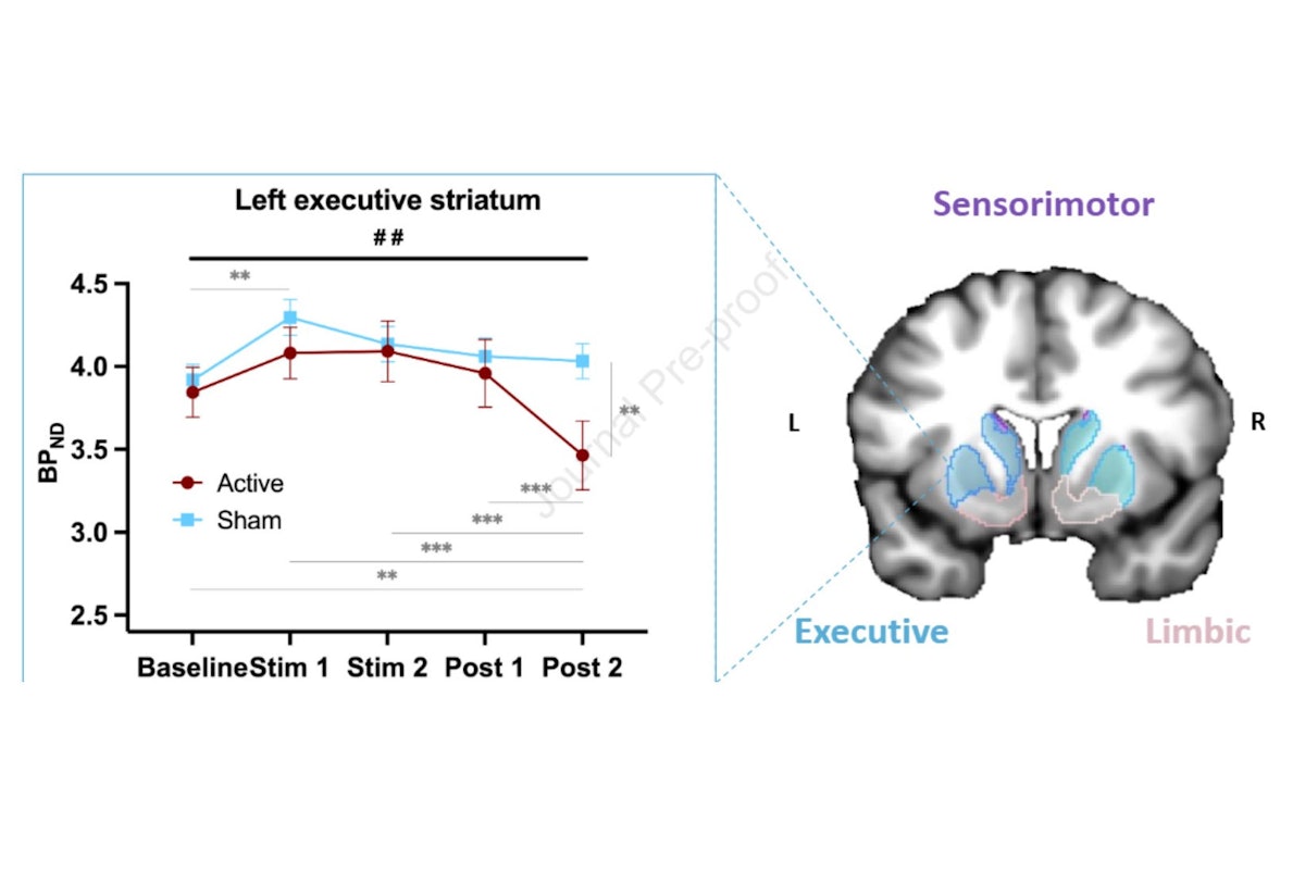 PET/MRI reveals how brain stimulation technique works | AuntMinnie