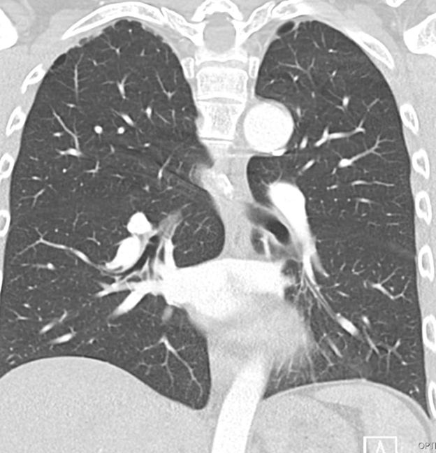 Imaging findings of Marfan syndrome: What radiologists need to know ...